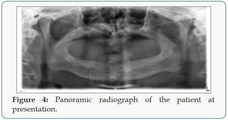 Rehabilitation of Atrophic Maxilla using Pterygoid Implants [Case Report]