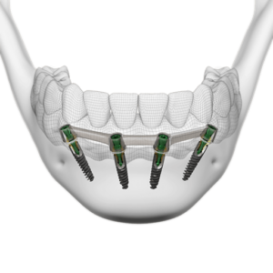 Sistemas de implantes dentales | ROOTT Dental Implant System
