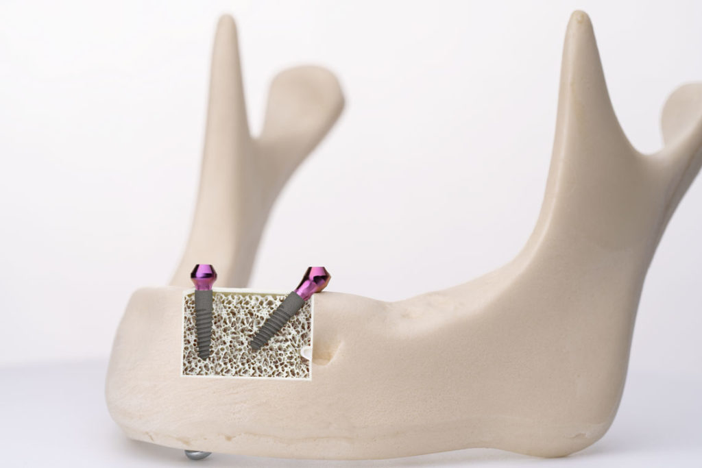 Angulated Multi-unit Abutments | ROOTT Dental Implant System