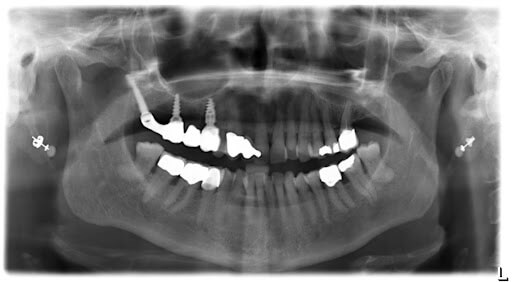 The added value of ROOTT implants: case reports