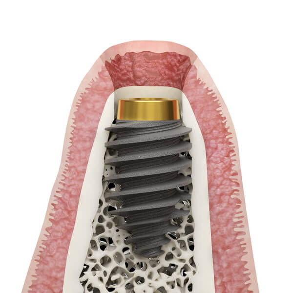 News, Articles, Case Studies | TRATE Dental Implants