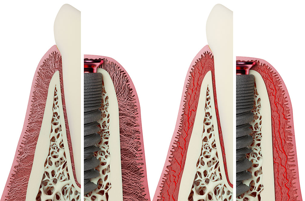 Modified Cover Screw To Enhance Long-Term Bone Stability In Two-Stage ...